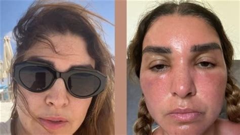 روجينا تصاب بحروق الشمس وتعلق اتحرقت وبقضي العيد مع الدكتور