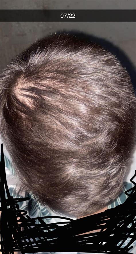 Worsening Of Diffuse Alopecia Despite Treatment Dutas 05 5mg Minox 1x