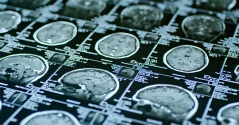 Infosalus Hallan Un Posible Tratamiento Que Podría Prevenir Las