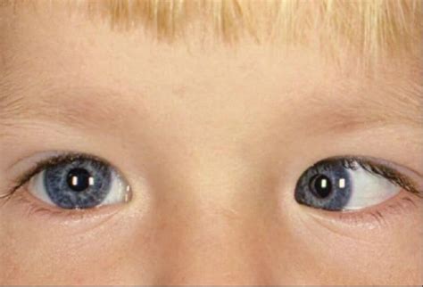 How To Assess Ocular Alignment Eye Science The Eye News