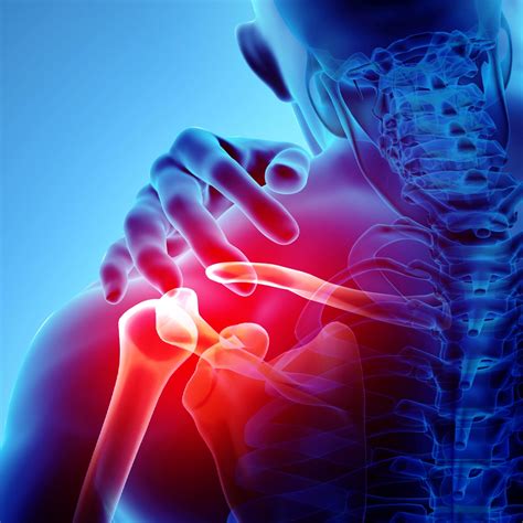 Shoulder Embolization Frozen Shoulder And Rotator Cuff Relief