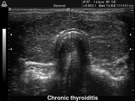 Thyroiditis
