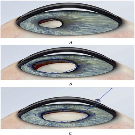 Combined Use Of An Iris Hook And Pupil Expansion Ring For Fe Journal Of Cataract