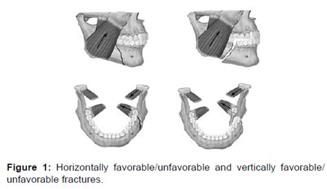 Mandibular Fracture Classification Fracture Of The Mandibular Condyle