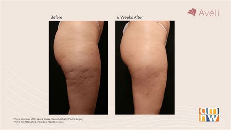 Aesthetic Medicine Treating Cellulite