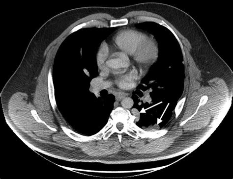 Ct Enhanced Image Axial Projection Displaying Nodularity Arrows Of Download Scientific