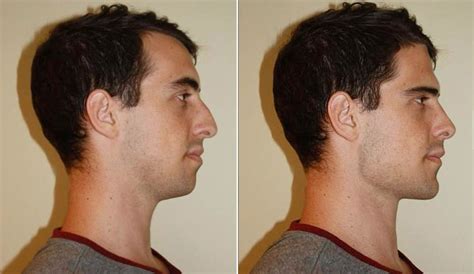Mewing Before After 122 Progress Photos Male Female Transformations