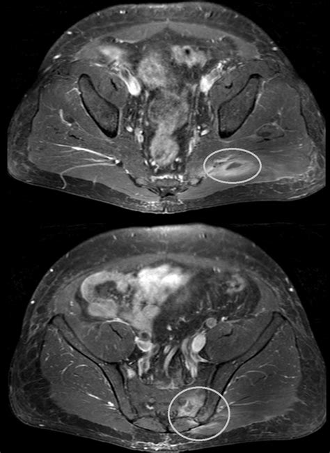 Gluteal Abscess Gluteal Abscess Definite Cure