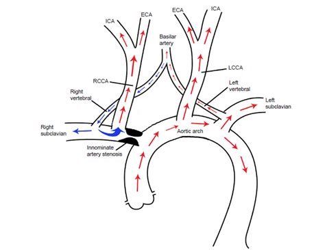 Causes Subclavian Steal Syndrome