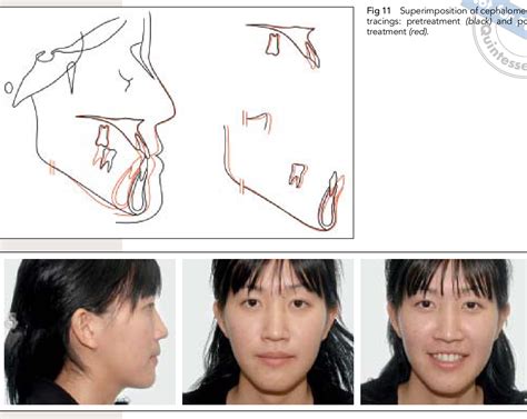 Figure 11 From Class Iii Occlusion With Missing Maxillary First Molars And Facial Asymmetry