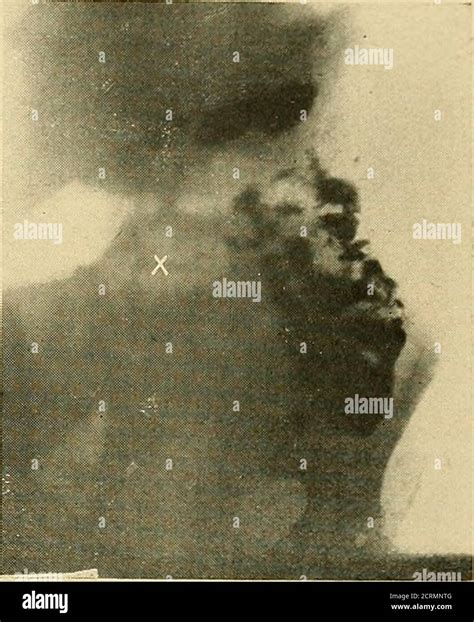 The Alimentary Tract A Radiographic Study Fig 60 Fig 61 Fig