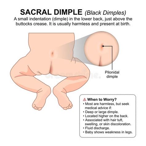 Sacral Dimple Stock Illustrations 1 Sacral Dimple Stock Illustrations