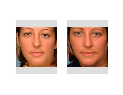 Correction Of Facial Asymmetry Dr Barry Eppley Indianapolis Explore Plastic Surgery