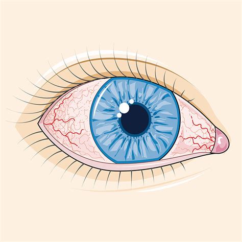 Conjunctivitis Vector Illustration