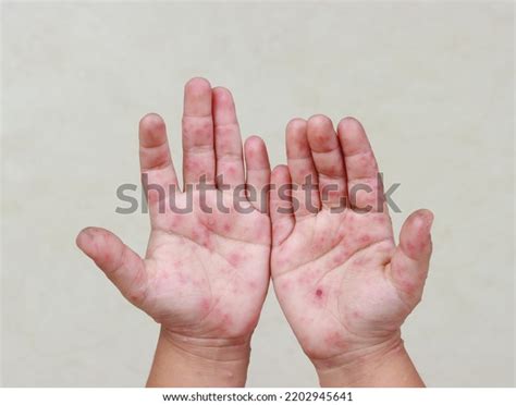 Hfmd Rash Red Blisters On Body Stock Photo 2202945641 Shutterstock