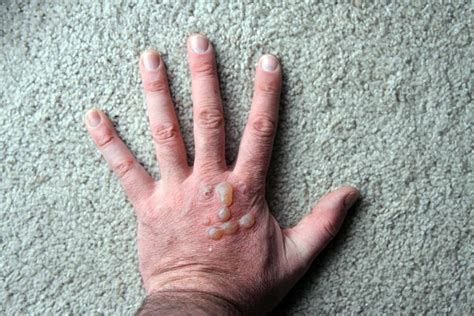 Sun Blisters On Hands