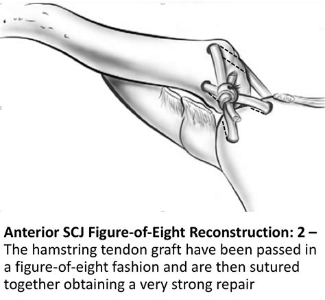 Anterior Dislocations Cambridge Shoulder