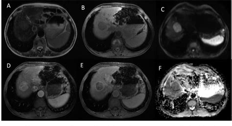 Figure 1 From Assessment Of Li Rads Efficacy In Classification Of