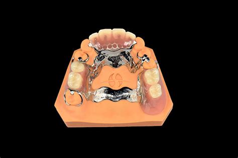 Dental Implants Removable Dentures Vitallium Metal Partial Denture