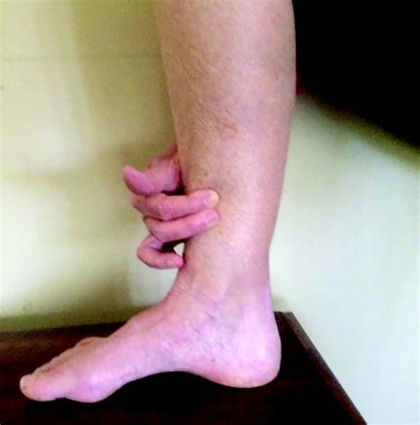 The Top Signs And Symptoms Of A Tibia Stress Fracture Flash Uganda Media