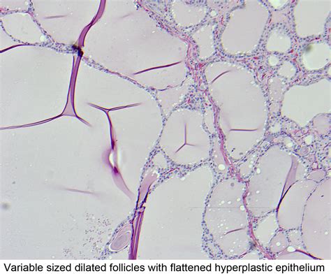 Pathology Outlines Thyroid Follicular Nodular Disease Multinodular Goiter