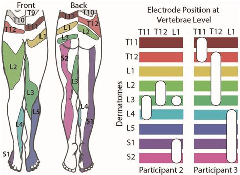 Dermatomal Activation By Electrodes Located At Different Vertebrae