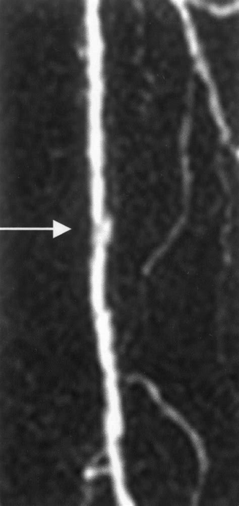 Peripheral Vascular Occlusive Disease Evaluation With Contrast