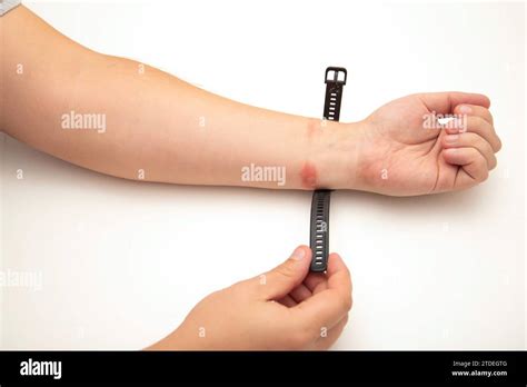 Allergic Reaction To Wrist Brace At Monte Rodriquez Blog