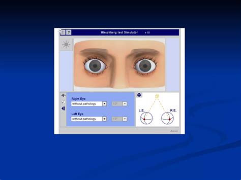 Diagnosis Evaluation In Strabismus Ppt