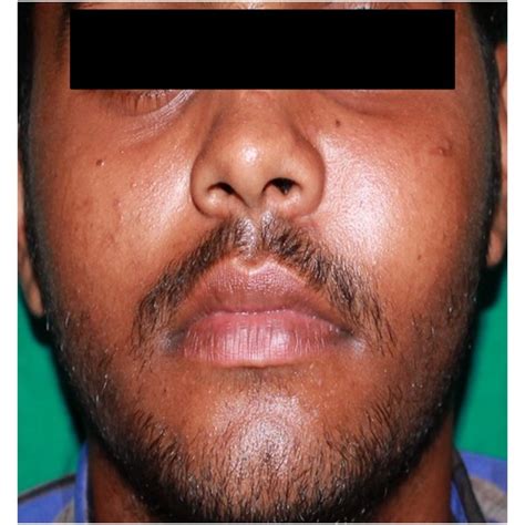 Pseudostratified Squamous Epithelium With Multiple Microcysts Hande 20x