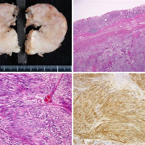 Figure5pathological Analysis Of The Gastric Mass Confirmed A Gastric Download Scientific
