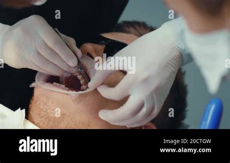 Dentist And Assistant With Special Tools Puts Braces To Man Mouth Teeth Reception At The