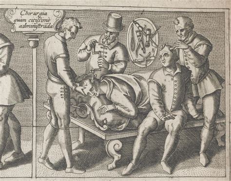 Trepanation Our Ancestors Idea Of Neurosurgery