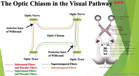 2j Chiasmal Disorders Flashcards Quizlet