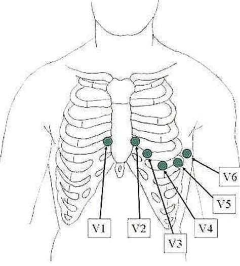 Pediatric Ecg Electrode Placement