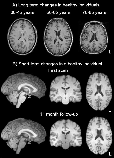 Two Examples Of Aging With Figure 1a Showing Long Term Aging In