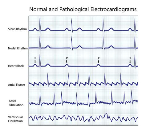 Atrial Flutter Cardiology Highland Hospital University Of