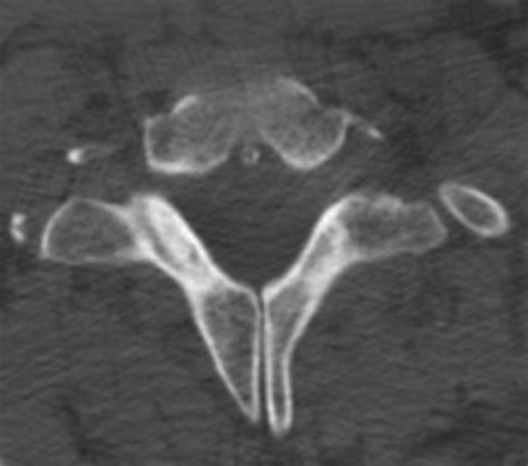 Is There An Anatomicalevolutionary Reason That Some Spinous Processes