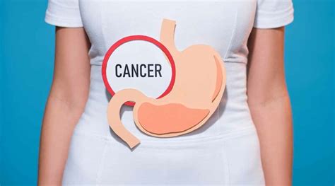 Señales De Cáncer De Estómago Saludyvida