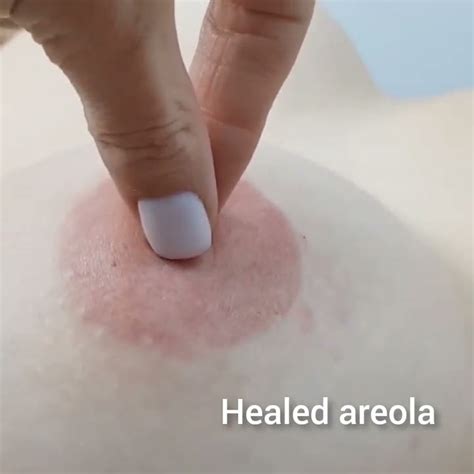 Breast Areola Restoration Nipple Tattoo In Floral Park Ny Youtube