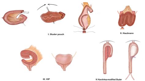 Orthotopic Bladder Substitution Surgical Aspects And Optimization Of