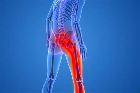 Lumbar Disc Herniation Spineplus