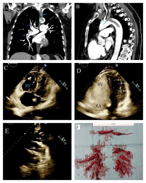 A Computed Tomography Pulmonary Angiogram Frontal Reconstruction