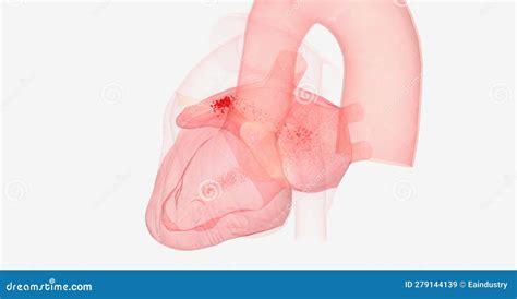 Appendage Thrombus Stock Illustrations 6 Appendage Thrombus Stock Illustrations Vectors