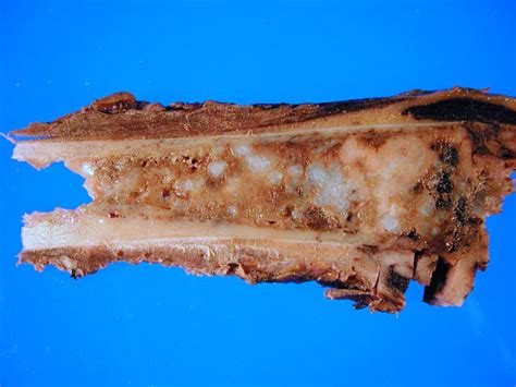 What Is Chondrosarcoma With Health