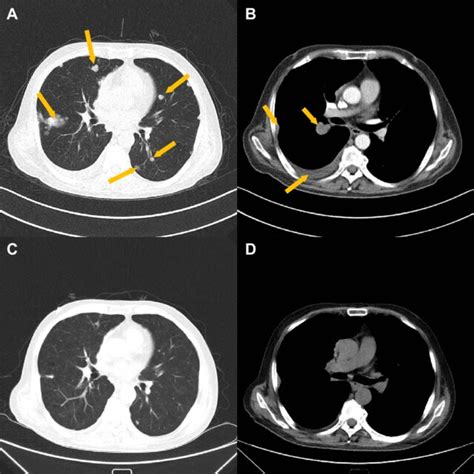 The Lung And Pleural Metastasis Were Reduced After Everolimus