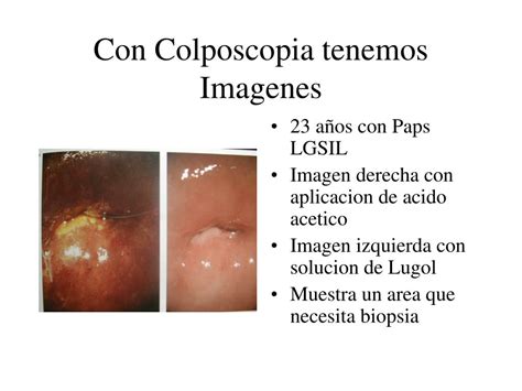 Ppt La Colposcopia Un Metodo Para Conocer Powerpoint Presentation