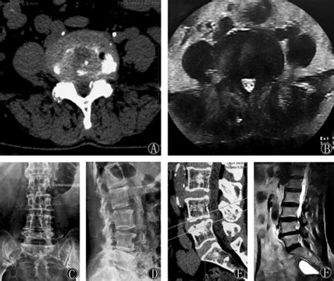 Early Clinical Evaluation Of Percutaneous Full‐endoscopic