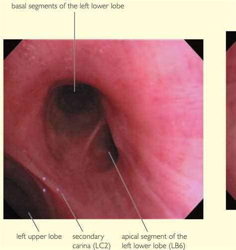 Figure 122 From Atlas Of Flexible Bronchoscopy
