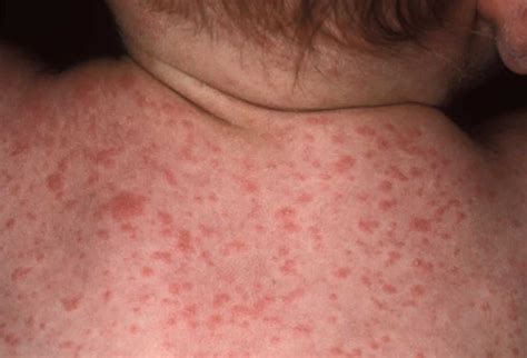 Typhoid Fever Rash
